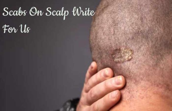 Scabs On Scalp Write For Us - Guest Post, Contribute, and Submit Post